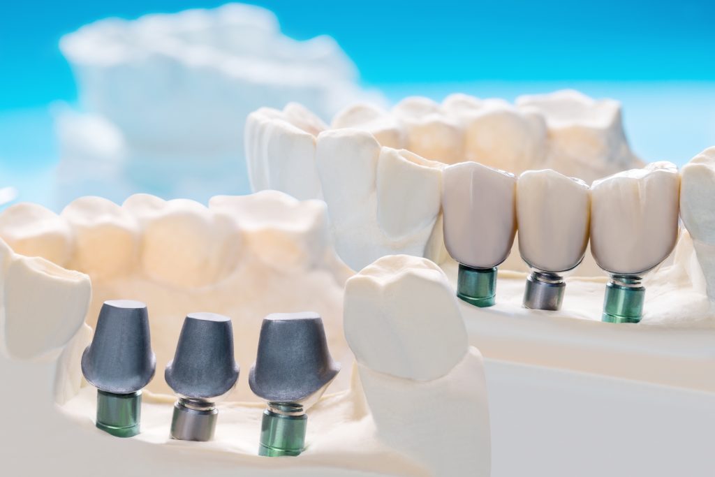 Complete Guide for Straumann Dental Implants - Dente Dental Studio